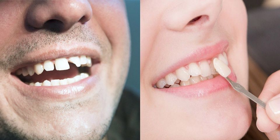 Tooth Bonding: Before, During And After - My BEST Dentists Journal ...