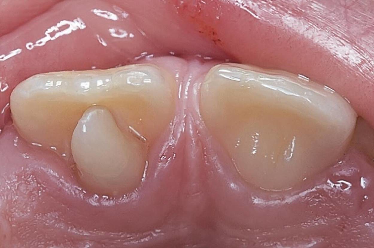 What Is The Cingulum Of The Tooth? - My BEST Dentists Journal ...