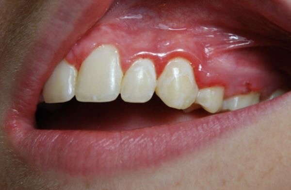 Causes and treatment of gingivitis - My BEST Dentists Journal ...