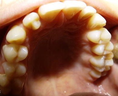 What Is The Cingulum Of The Tooth? - My BEST Dentists Journal ...
