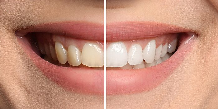 Is Whitening Toothpaste Effective? - My BEST Dentists Journal ...