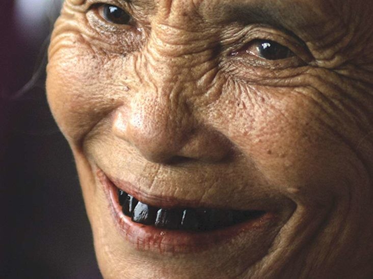 Black Teeth: Symptoms, Causes and Treatment - My BEST Dentists Journal ...