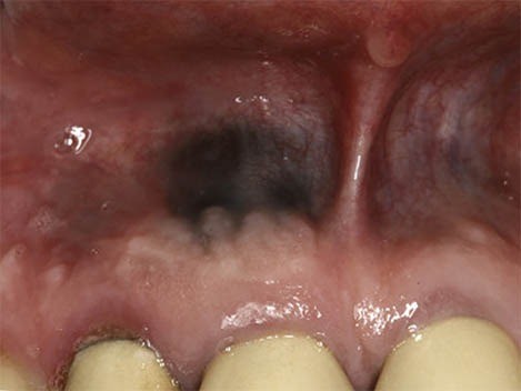 What Causes a Dark Spot on Gums? - My BEST Dentists Journal ...