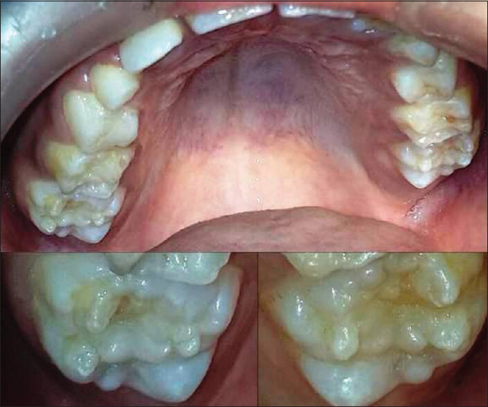 What Are Mulberry Molars? - My BEST Dentists Journal - MyBestDentists