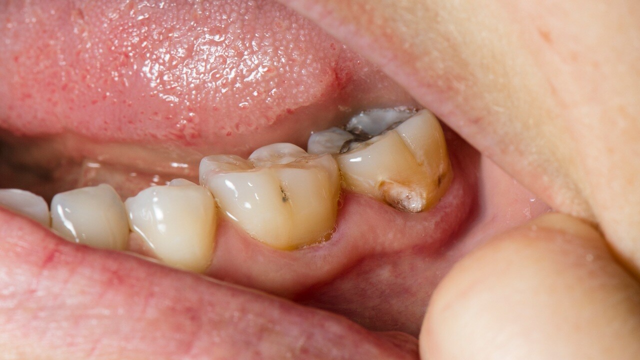 Rampant Caries: What Are They? - My BEST Dentists Journal - MyBestDentists