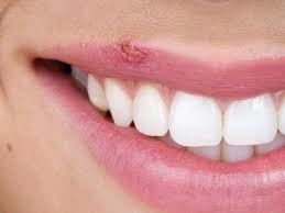 What Causes a Scab on the Lip? - My BEST Dentists Journal - MyBestDentists