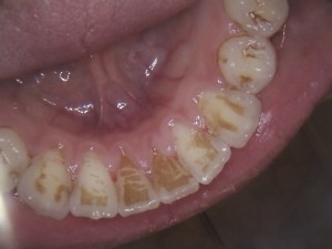 Craze Lines on Your Teeth Making You Crazy? - My BEST Dentists Journal ...