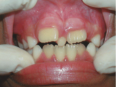 What Kind of Tooth is a Mesiodens? - My BEST Dentists Journal ...