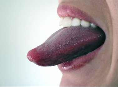 Reasons Why Your Tongue Is Purple - My BEST Dentists Journal ...