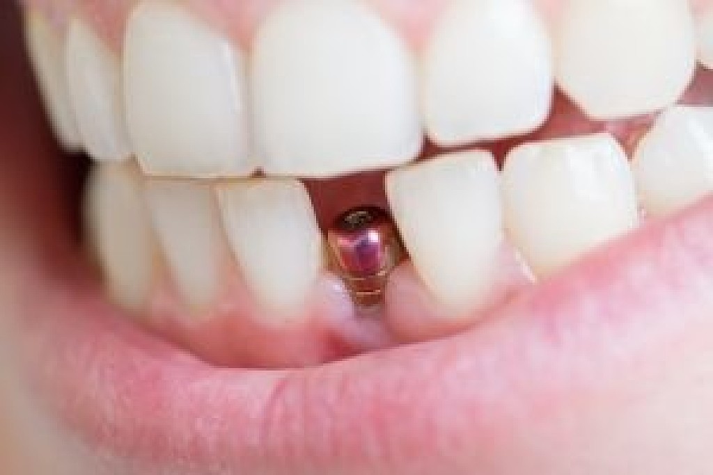 Front Tooth Replacement Options - My BEST Dentists Journal - MyBestDentists
