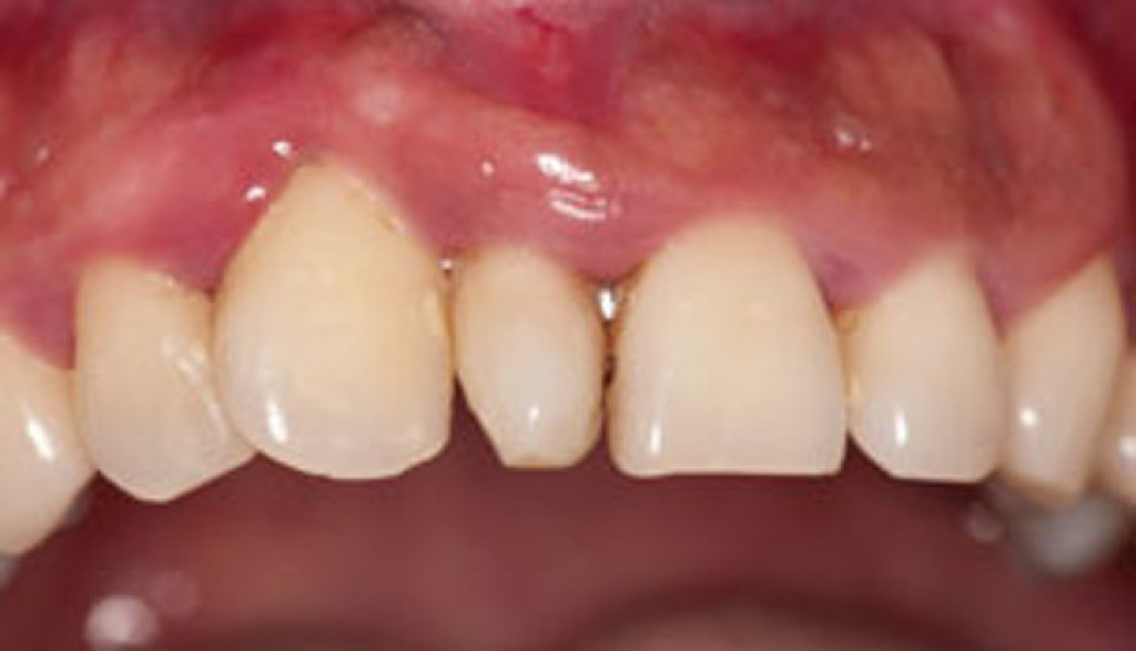 What Kind of Tooth is a Mesiodens? - My BEST Dentists Journal ...